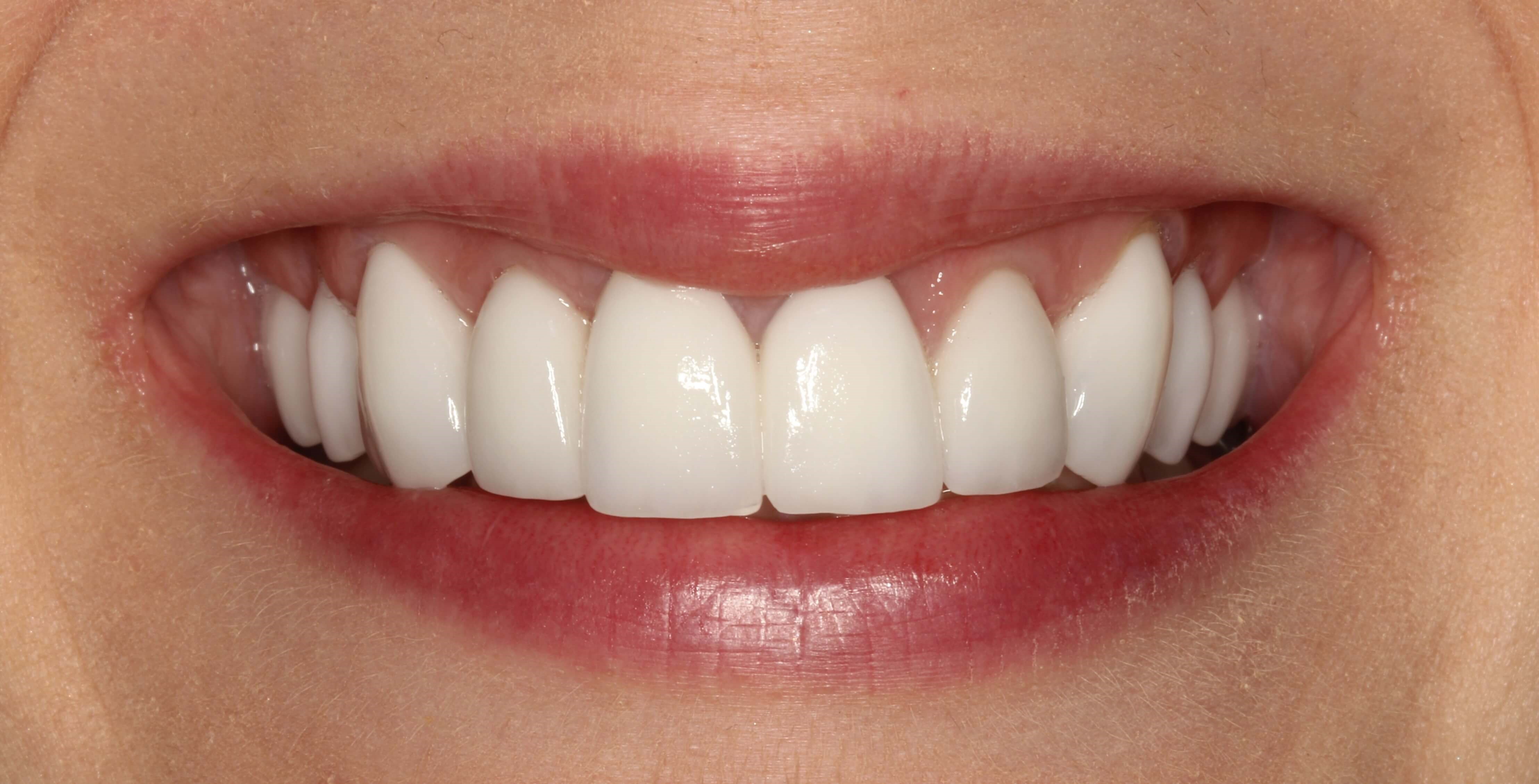Before And After Gum Surgery Dental Crowns Smile Makeover before-and-after-gum-surgery-dental-crowns-smile-makeover